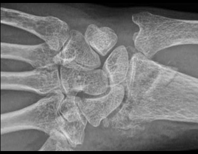 Hand and Wrist Education Resources - American Academy of Orthopaedic ...