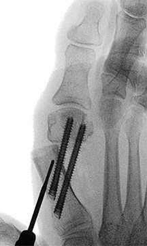 Foot and Ankle Surgeons Eagerly Welcome New MIS Techniques