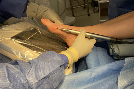 Foot and Ankle Surgeons Eagerly Welcome New MIS Techniques