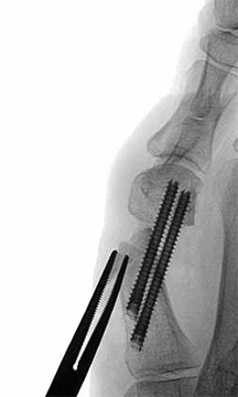 Foot and Ankle Surgeons Eagerly Welcome New MIS Techniques