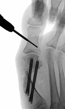 Foot and Ankle Surgeons Eagerly Welcome New MIS Techniques