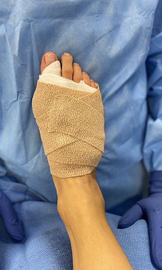 Foot and Ankle Surgeons Eagerly Welcome New MIS Techniques