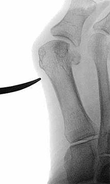 Foot and Ankle Surgeons Eagerly Welcome New MIS Techniques