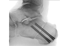 Foot and Ankle Surgeons Eagerly Welcome New MIS Techniques