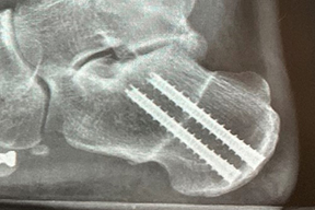 Foot and Ankle Surgeons Eagerly Welcome New MIS Techniques