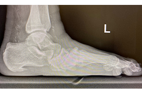 Foot and Ankle Surgeons Eagerly Welcome New MIS Techniques