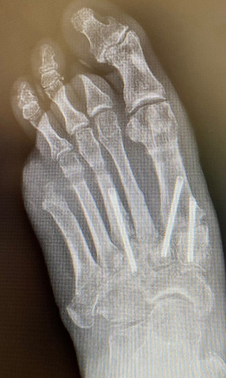 Foot and Ankle Surgeons Eagerly Welcome New MIS Techniques