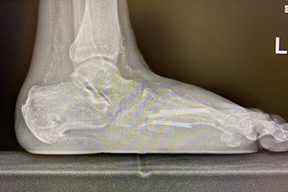 Foot and Ankle Surgeons Eagerly Welcome New MIS Techniques