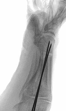 Foot and Ankle Surgeons Eagerly Welcome New MIS Techniques